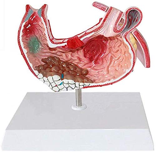 Buy Model Demonstration Model of tric Lesions of the digestive system ...