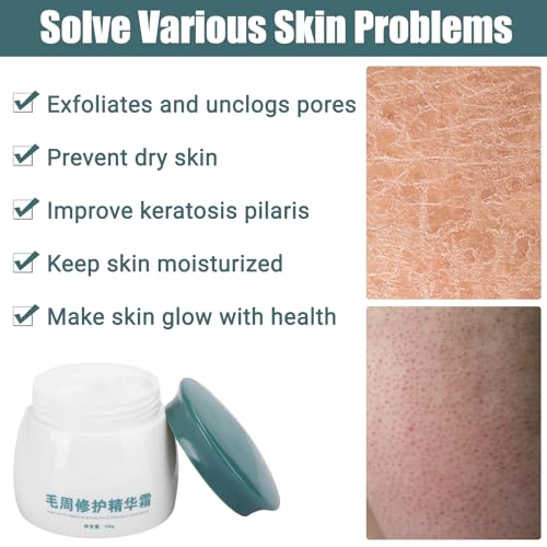 Keratosis Pilaris Cream, Keratosis Pilaris Treatment, Chicken Skin ...