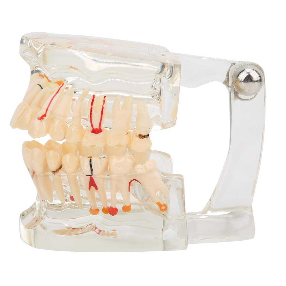 Buy Dental Teeth Models Transparent Disease Teeth Model Dental Im Teeth ...