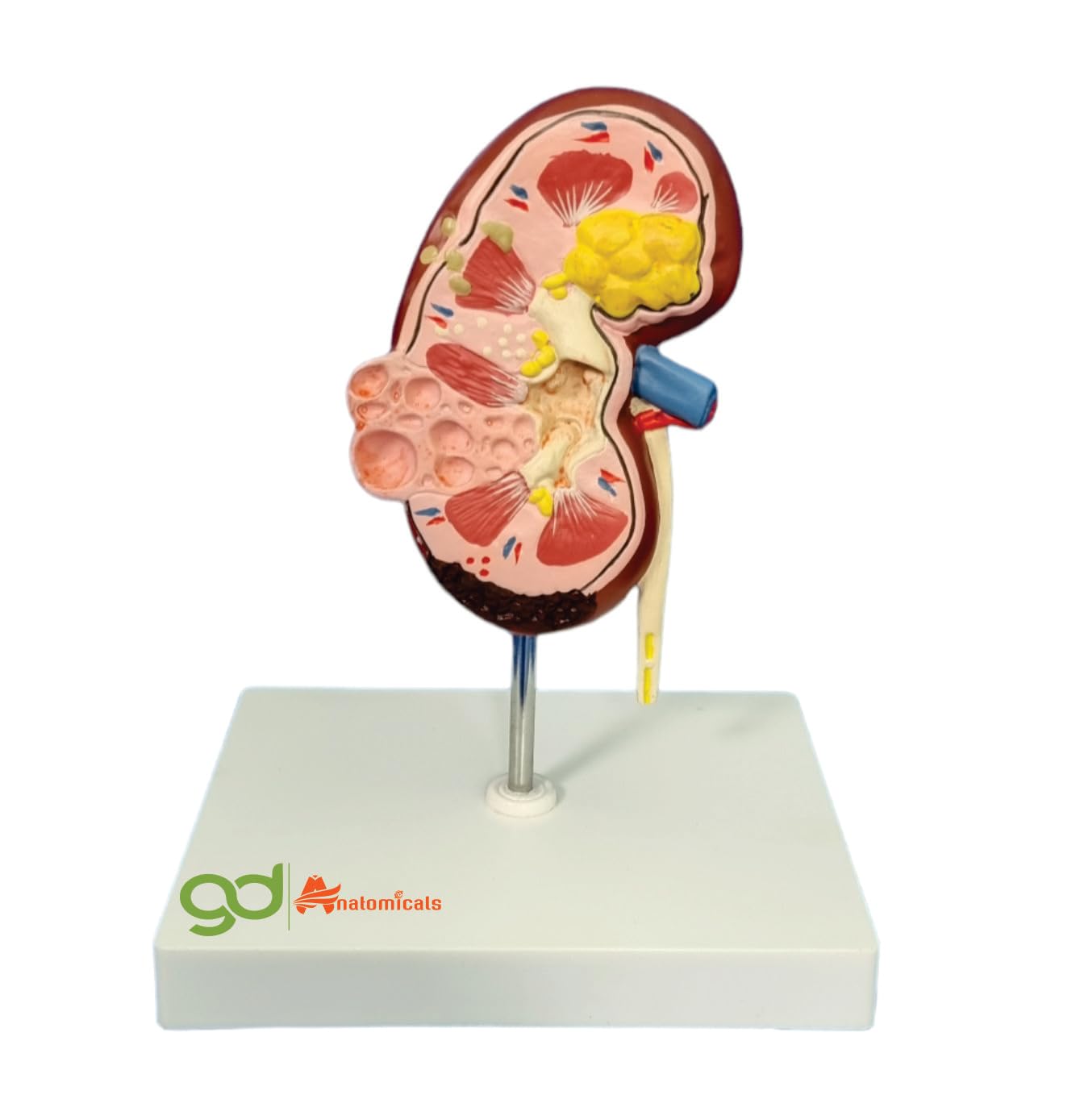 GD ANATOMICALS® Kidney Model with Pathologies - Educational Anatomy ...