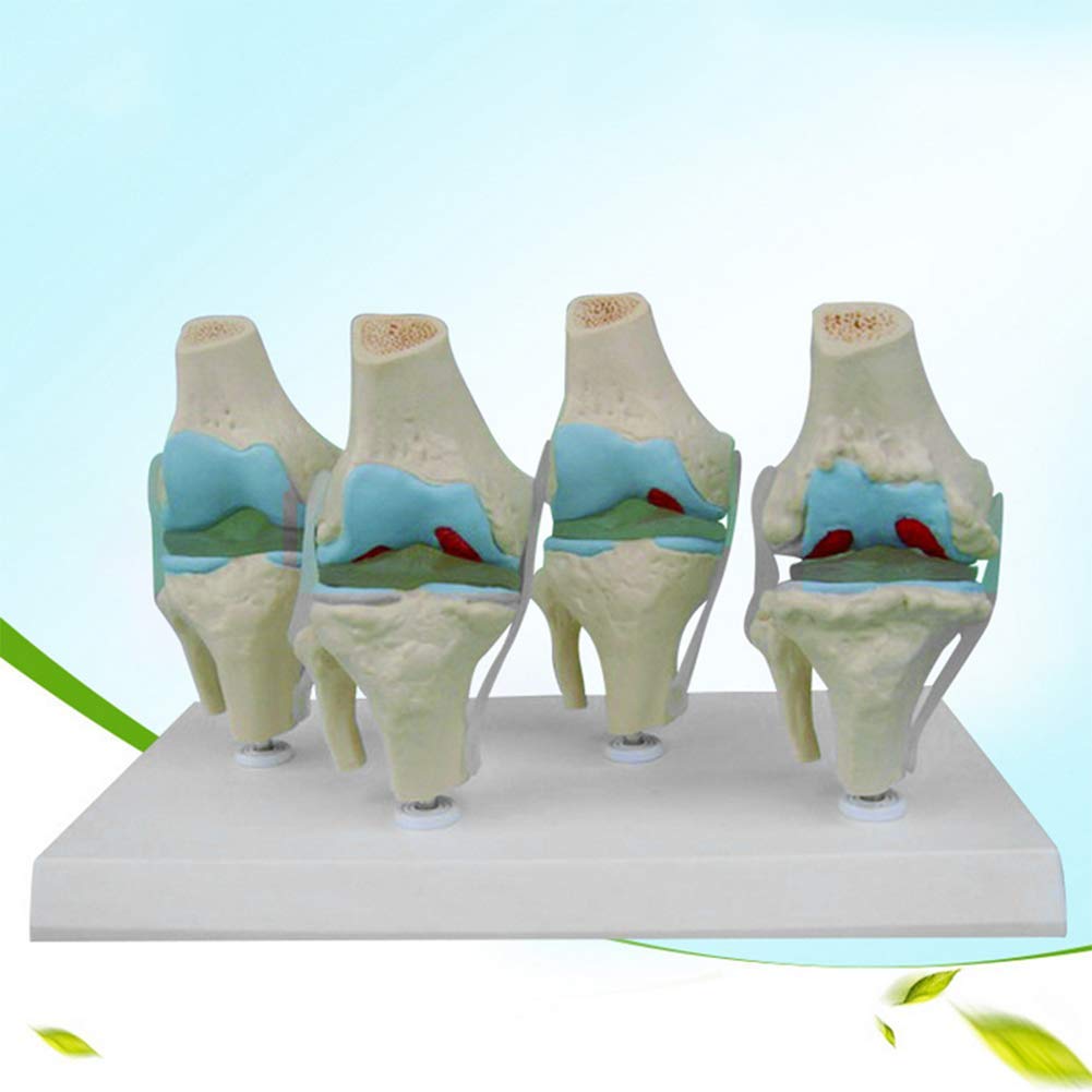 Buy QWER Knee Joint-Pathology Model Life Size Human Anatomy Morbid ...
