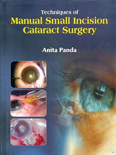 Techniques of Manual Small Incision Cataract Surgery: 9788123918556 ...