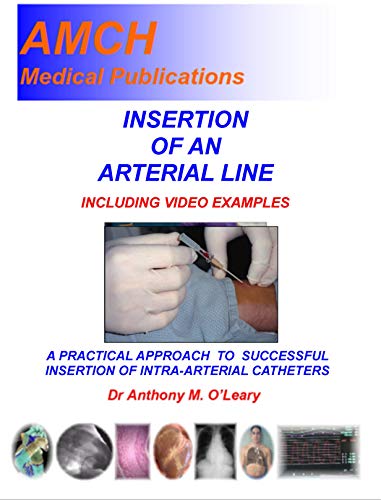INSERTION OF AN ARTERIAL LINE: A practical approach to successful ...