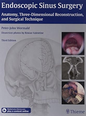 Endoscopic Sinus Surgery: Wormald: 9789382076162: Amazon.com: Books