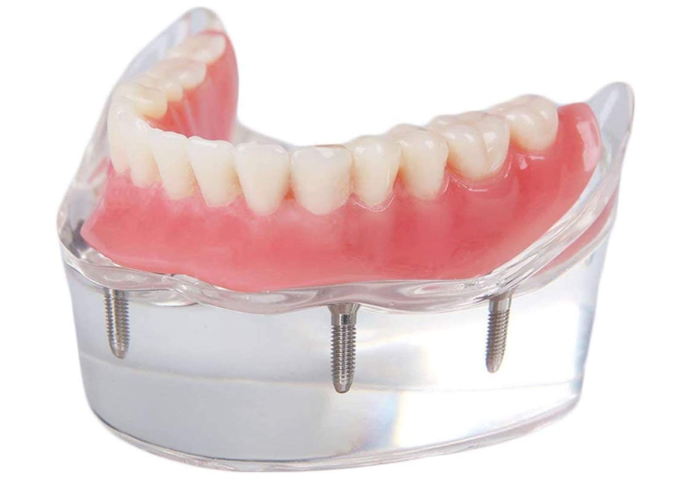 Buy Overdenture dental teaching model with 4 ims, study dental ...