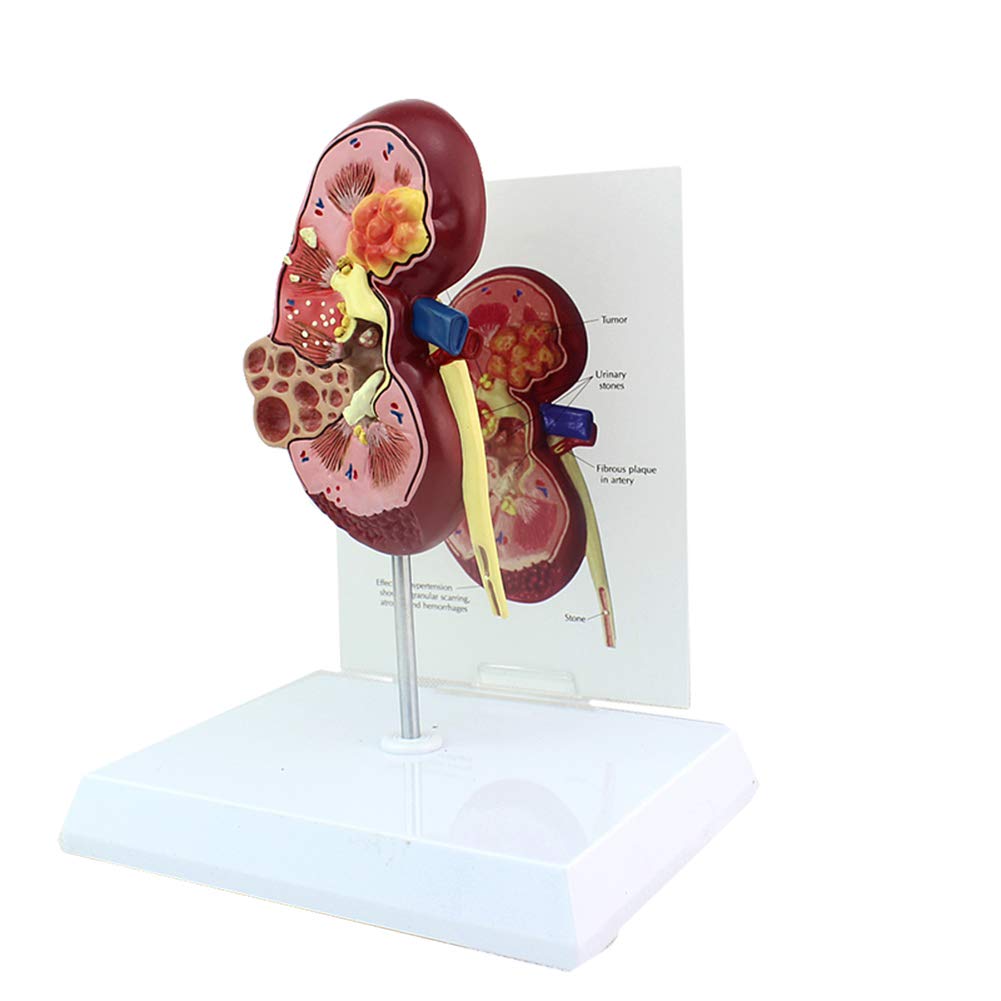 Buy Human Body Kidney Lesion Model Doctor-Patient Communication Zoom in ...