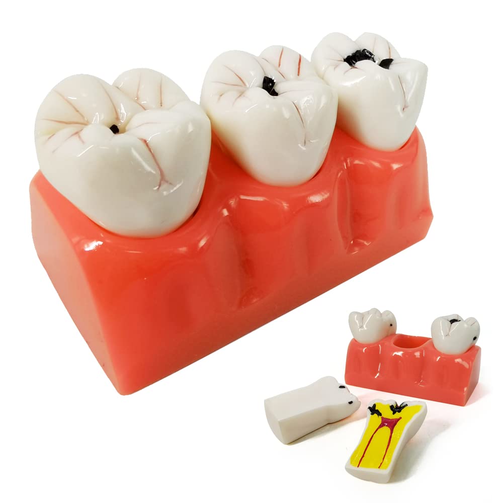 Buy Dental Model Dental Pathological Model Lesion Dental Model Dental buy-dental-model-dental-pathological-model-lesion-dental-model-dental