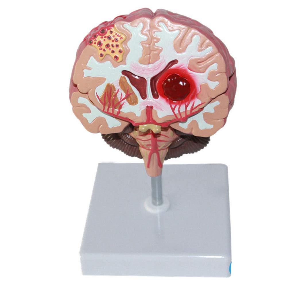 Buy Humans Brain Disease Model Neurosurgery Cerebral Hemorrhage Model ...