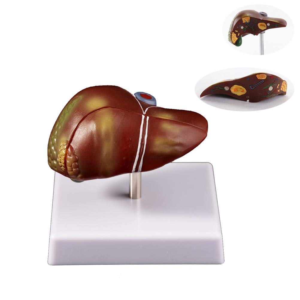 Buy Human Liver Pathological Model for School Medical Teaching Display ...