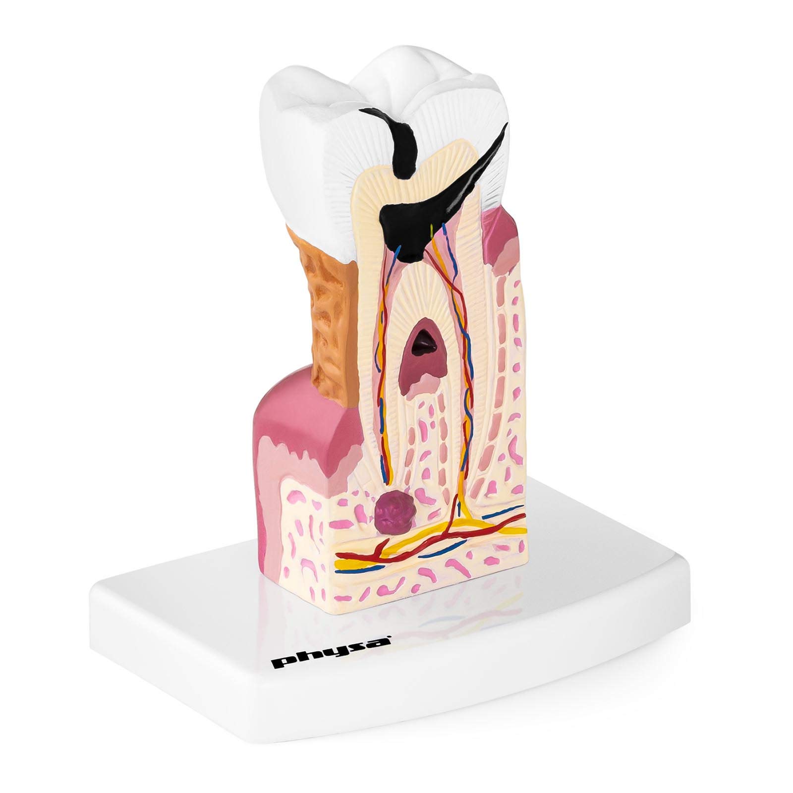 Buy Physa Human Tooth Model Diseased Molar Medical Dental Model ...