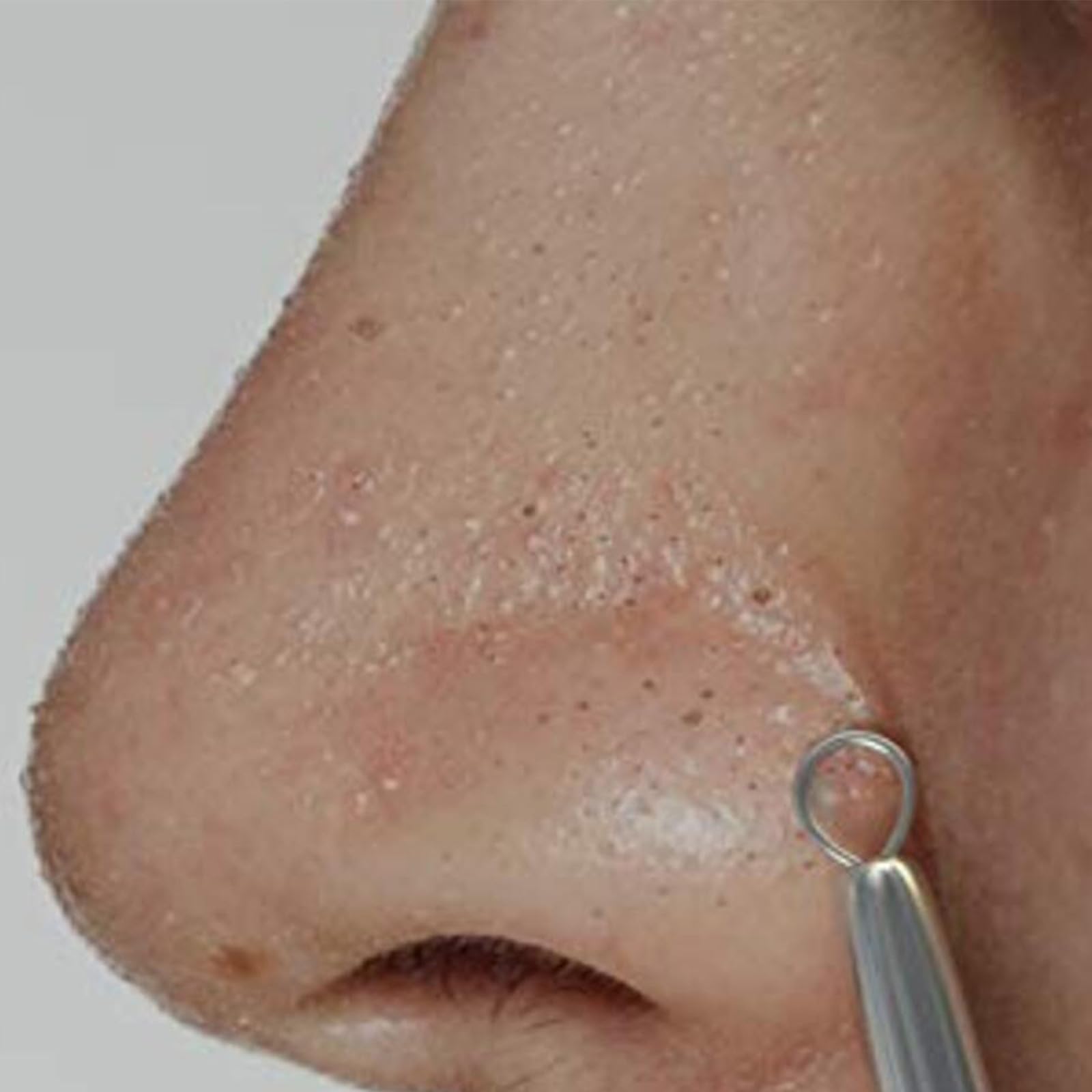 Stainless Steel Lancet Needle Acne Blackhead Remover Pimple Extractor ...