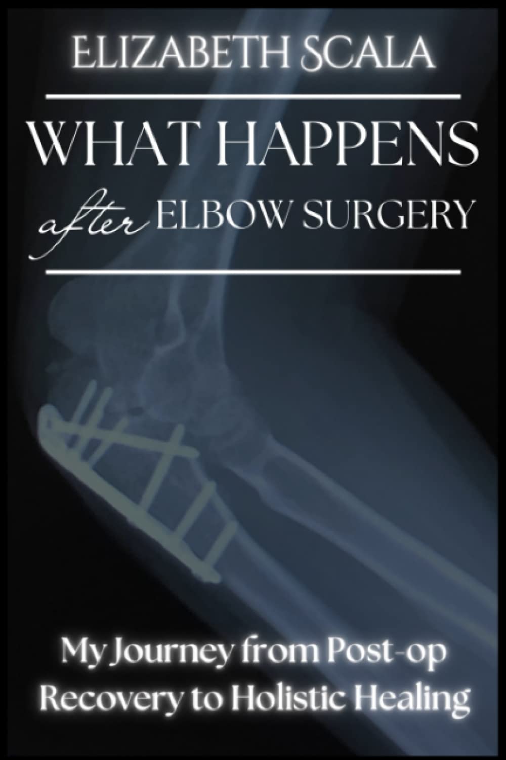 What Happens after Elbow Surgery: My Journey from Post-op Recovery to ...