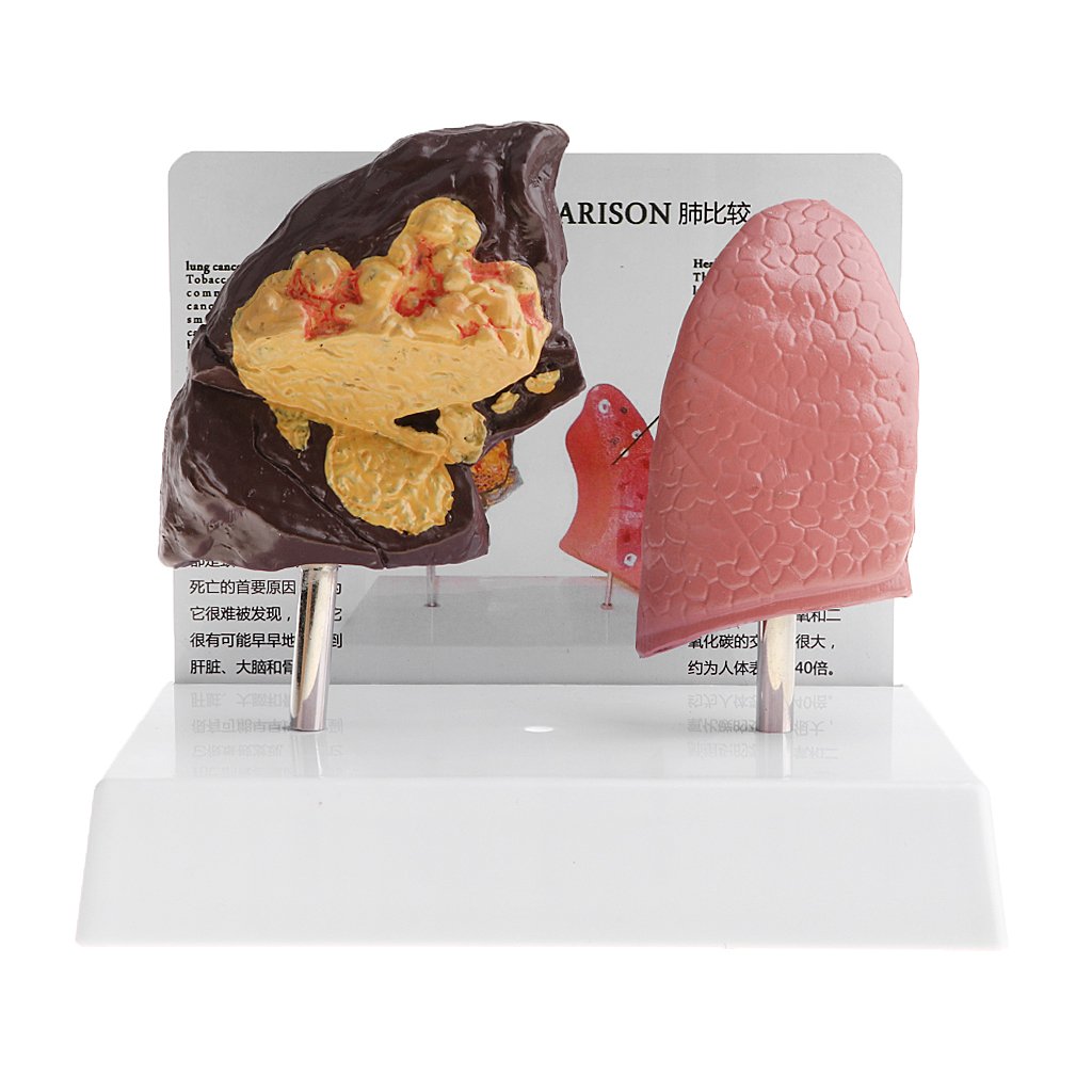 Buy Toygogo 4D-Vision Human Lungs Comparison Model Set : Normal and ...