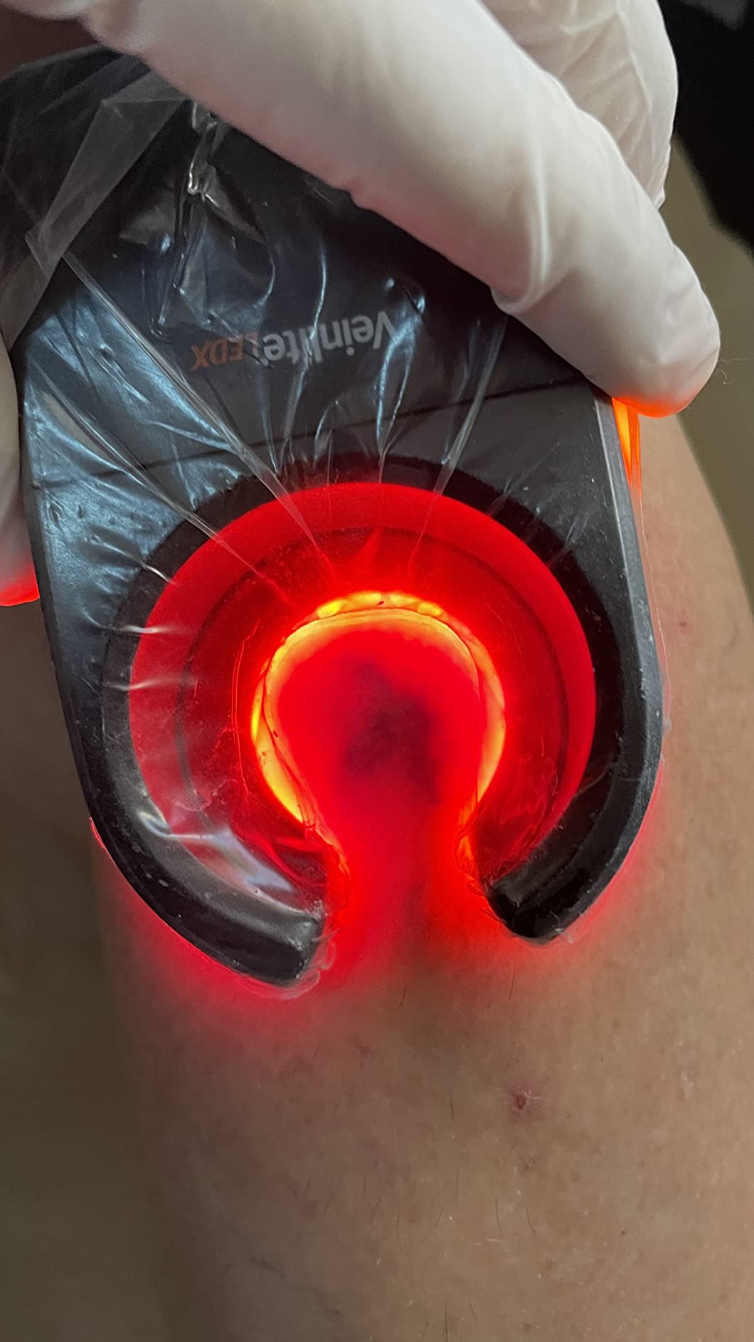 Amazon.com: Veinlite LEDX 靜脈查找器 – 硬化治療靜脈曲張映射和存取裝置。 The Gold Standard,由 All Major Vein Treatment ...