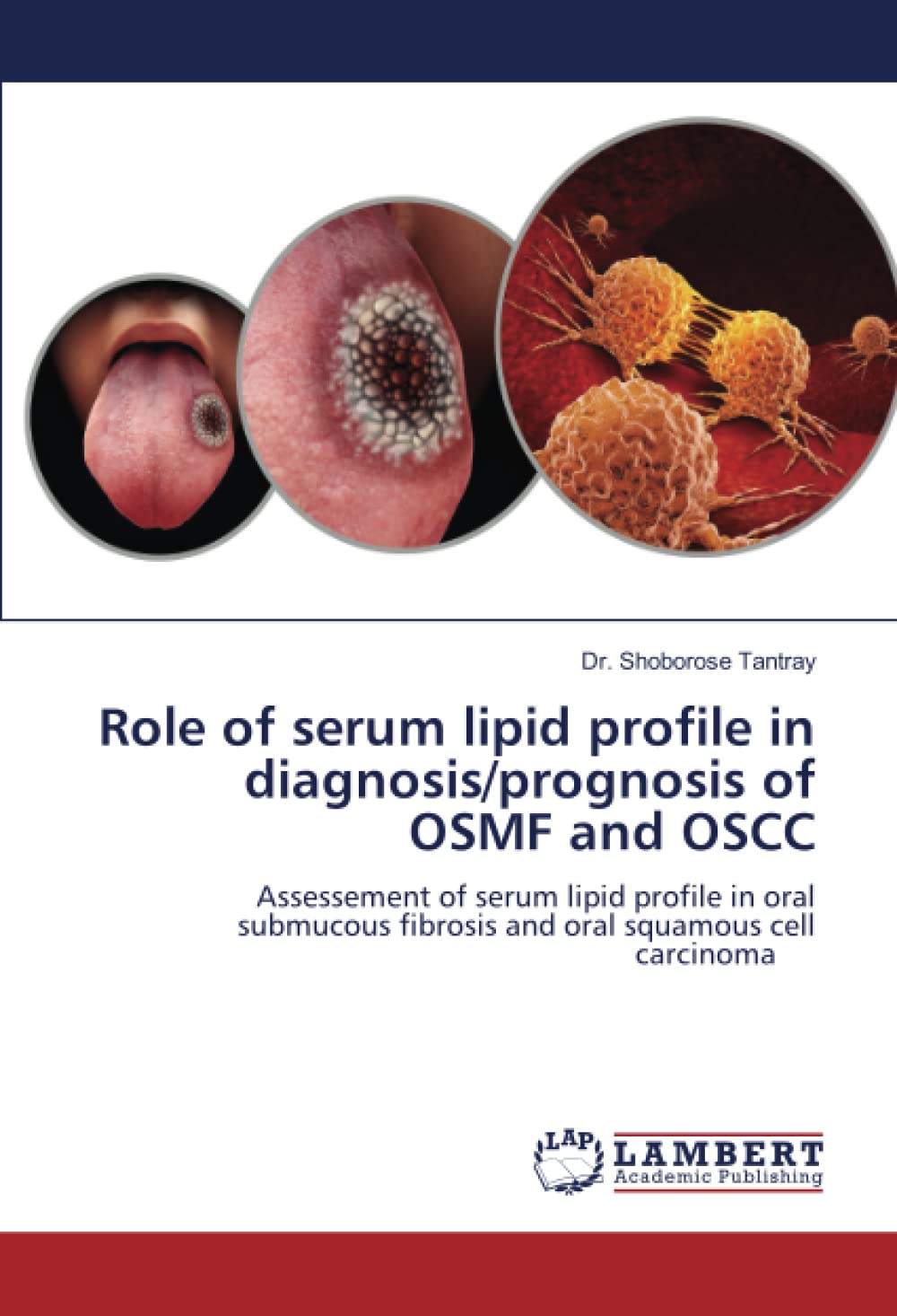 Buy Role of serum lipid profile in diagnosis/prognosis of OSMF and OSCC ...