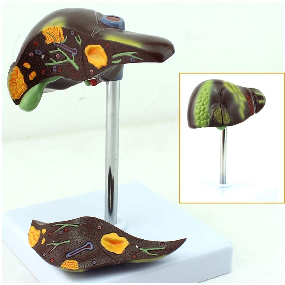 Buy Anatomy Model, Liver Pathology Model - Human Organ Anatomical Model ...