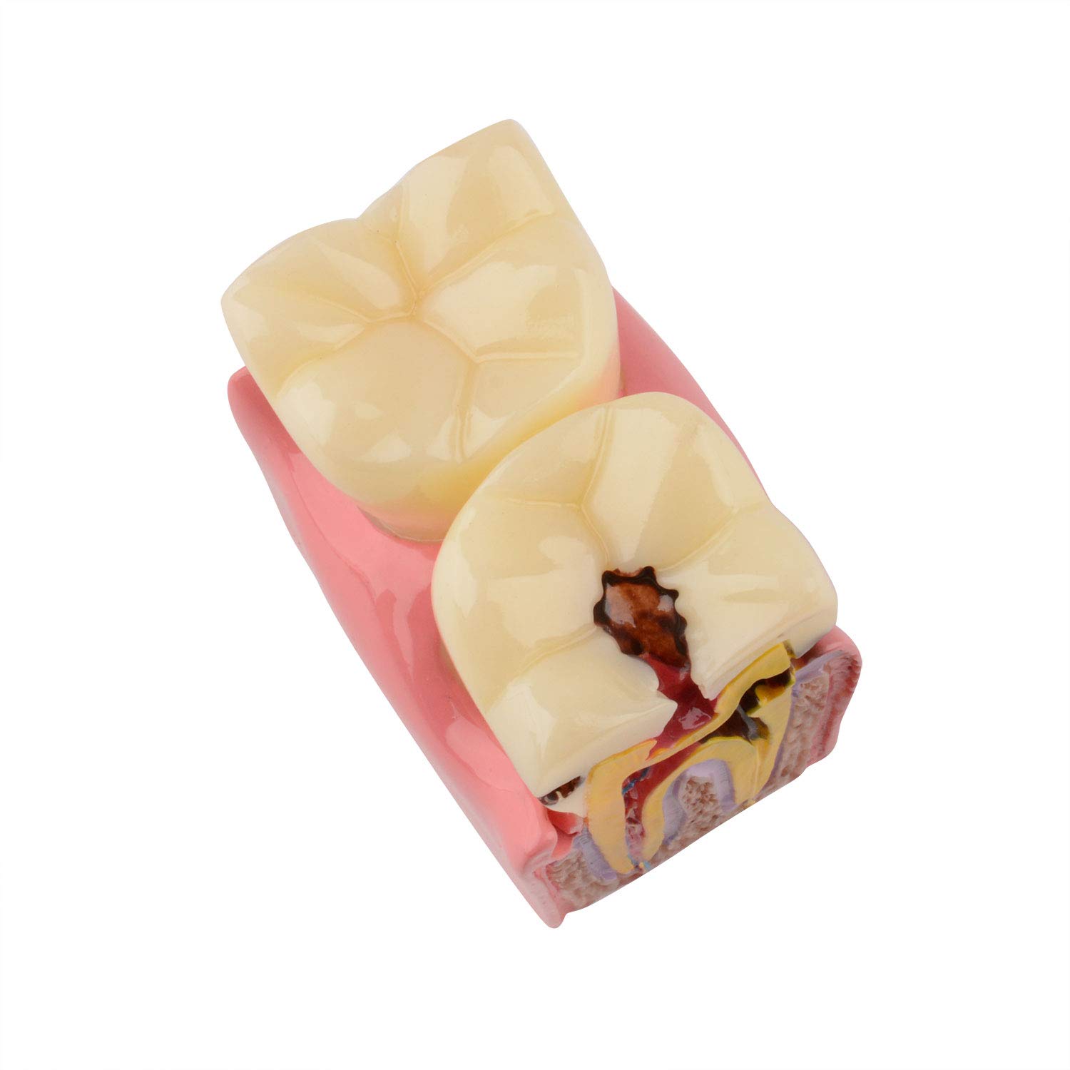 Snapklik.com : Ultrassist Dental Tooth Decay Model 6 Times Dental ...