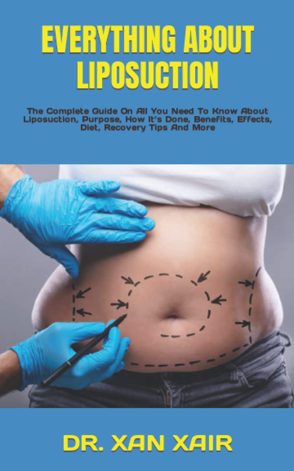 Buy EVERYTHING ABOUT LIPOSUCTION: The Complete Guide On All You Need To ...