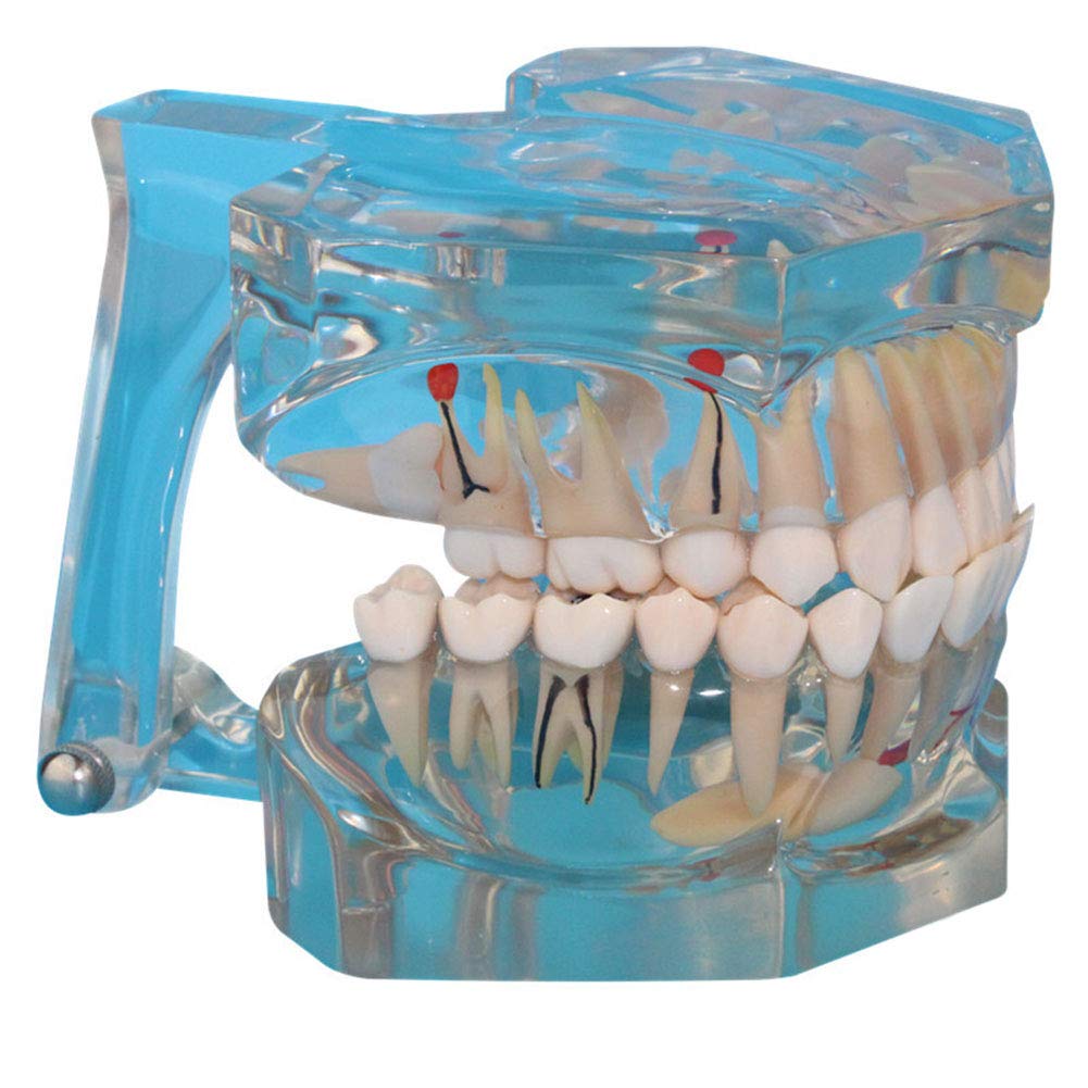 Buy Human Fangs Model, Showing Caries, Wedge Shaped Defect Fusion Root ...