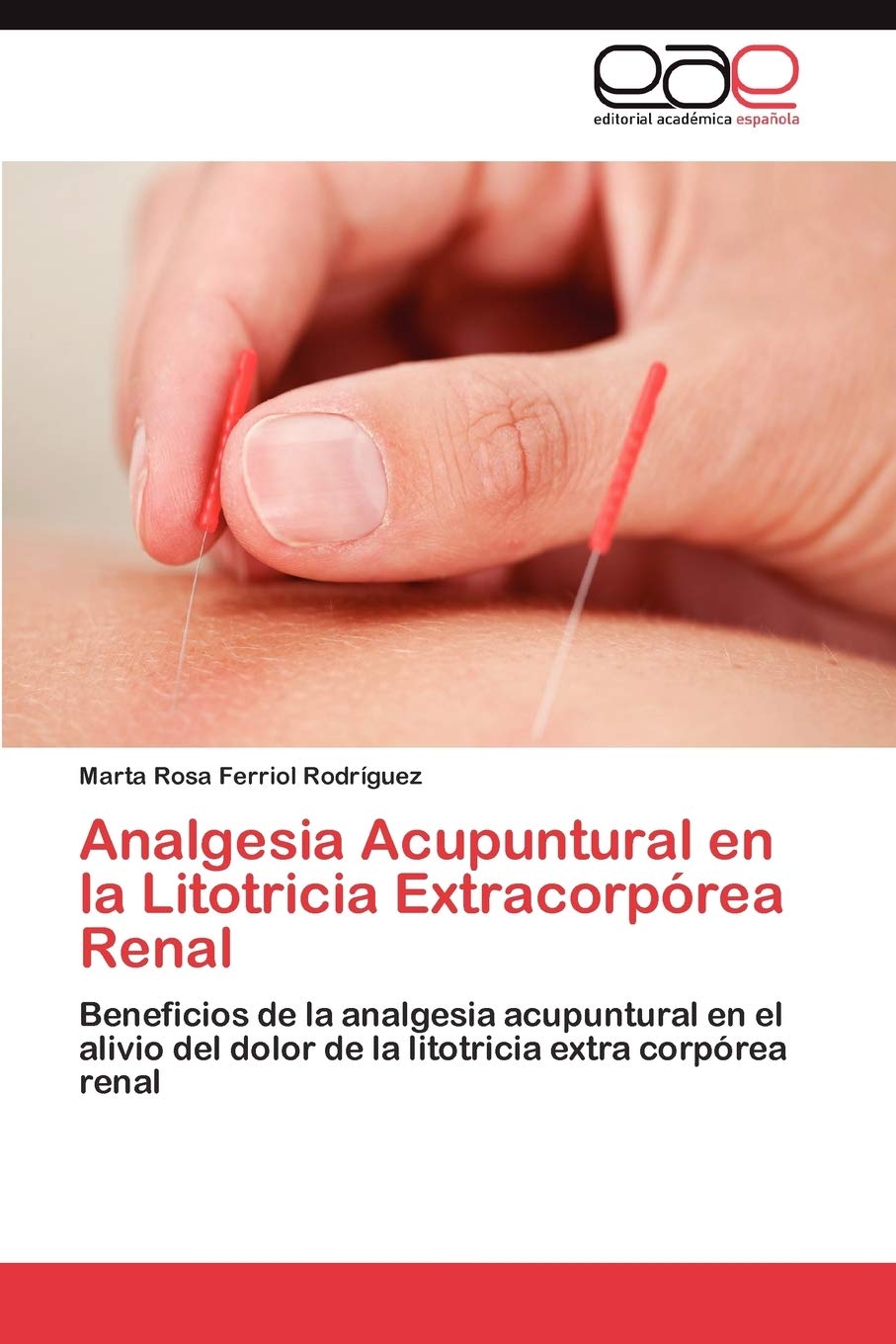 Buy Analgesia Acupuntural En La Litotricia Extracorporea Renal Online ...