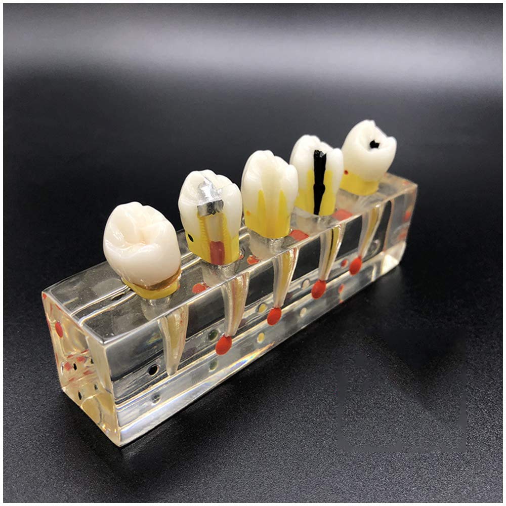 Buy XINIAN Dental 5-Stage Endodontic Model - Dental Teeth Study ...