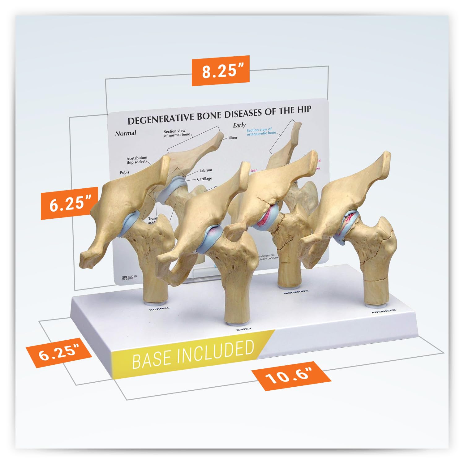 Snapklik.com : 4-Stage Diseased Hip Joint Model Set, Degenerative Bone ...