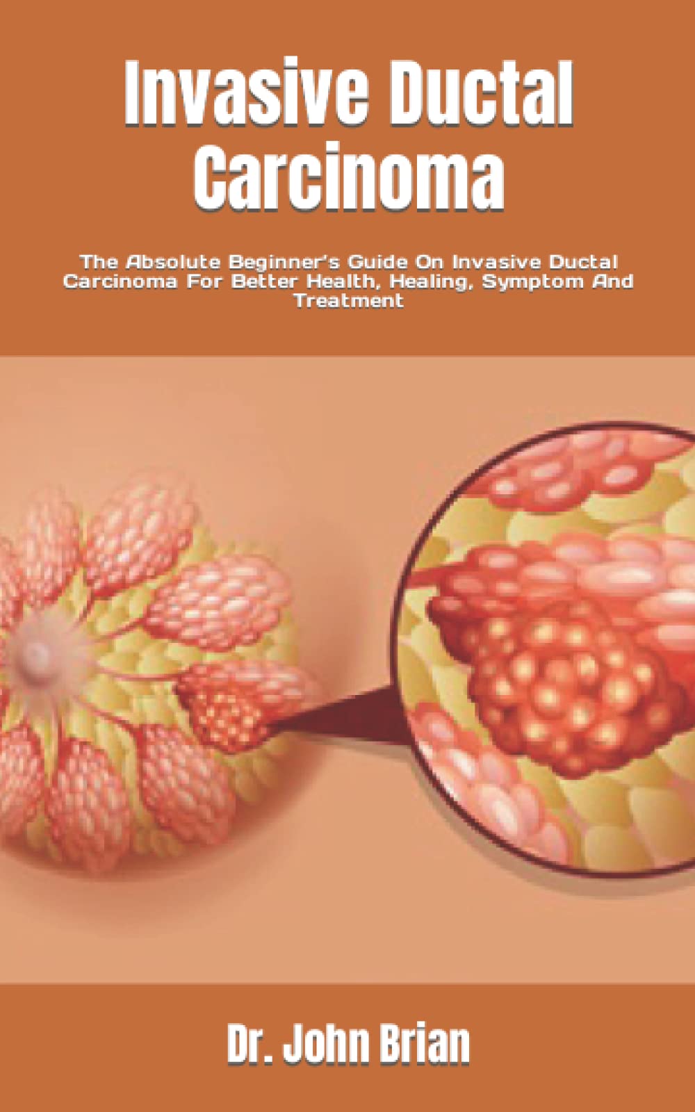 Buy Invasive Ductal Carcinoma: The Absolute Beginner’s Guide On ...