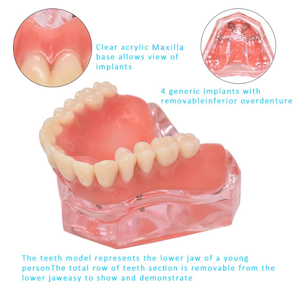 Buy Dental Model Overdenture Inferior Precision Implants Demo Removable ...