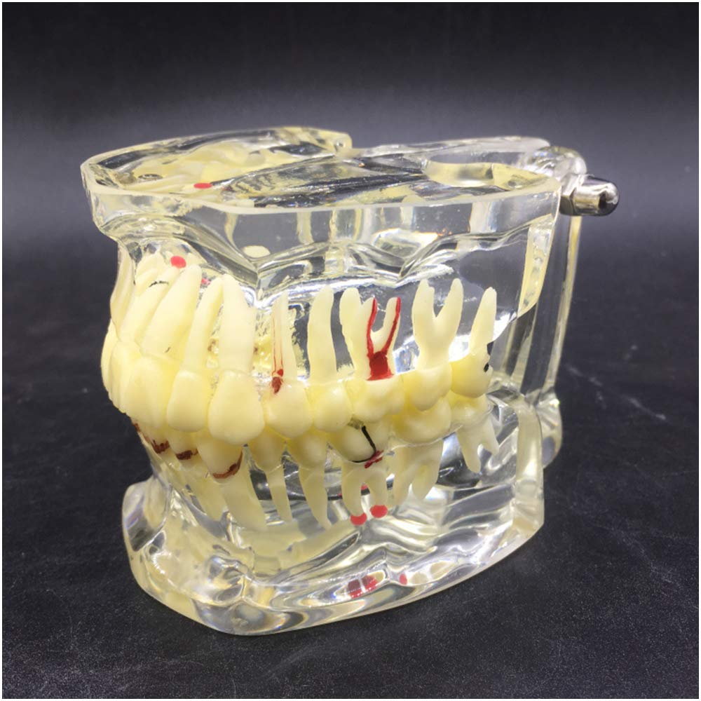 Buy FHUILI Dental Study Teaching Teeth Model - Teeth Pathology Model ...