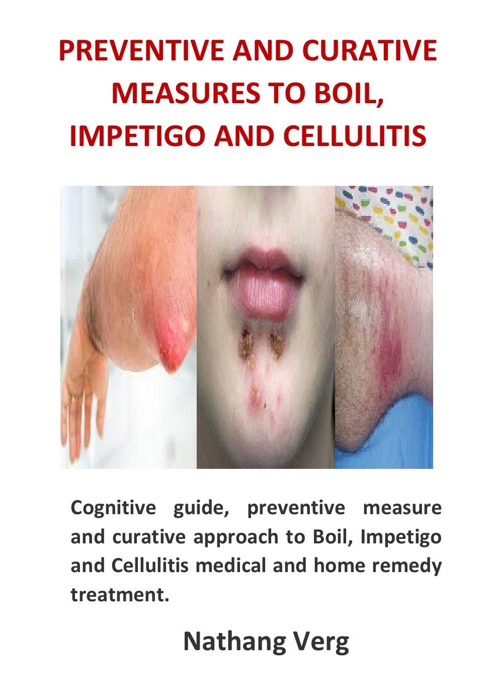 Buy Preventive and Curative Measures to Boil, Impetigo and Cellulitis: Cognitive guide ...