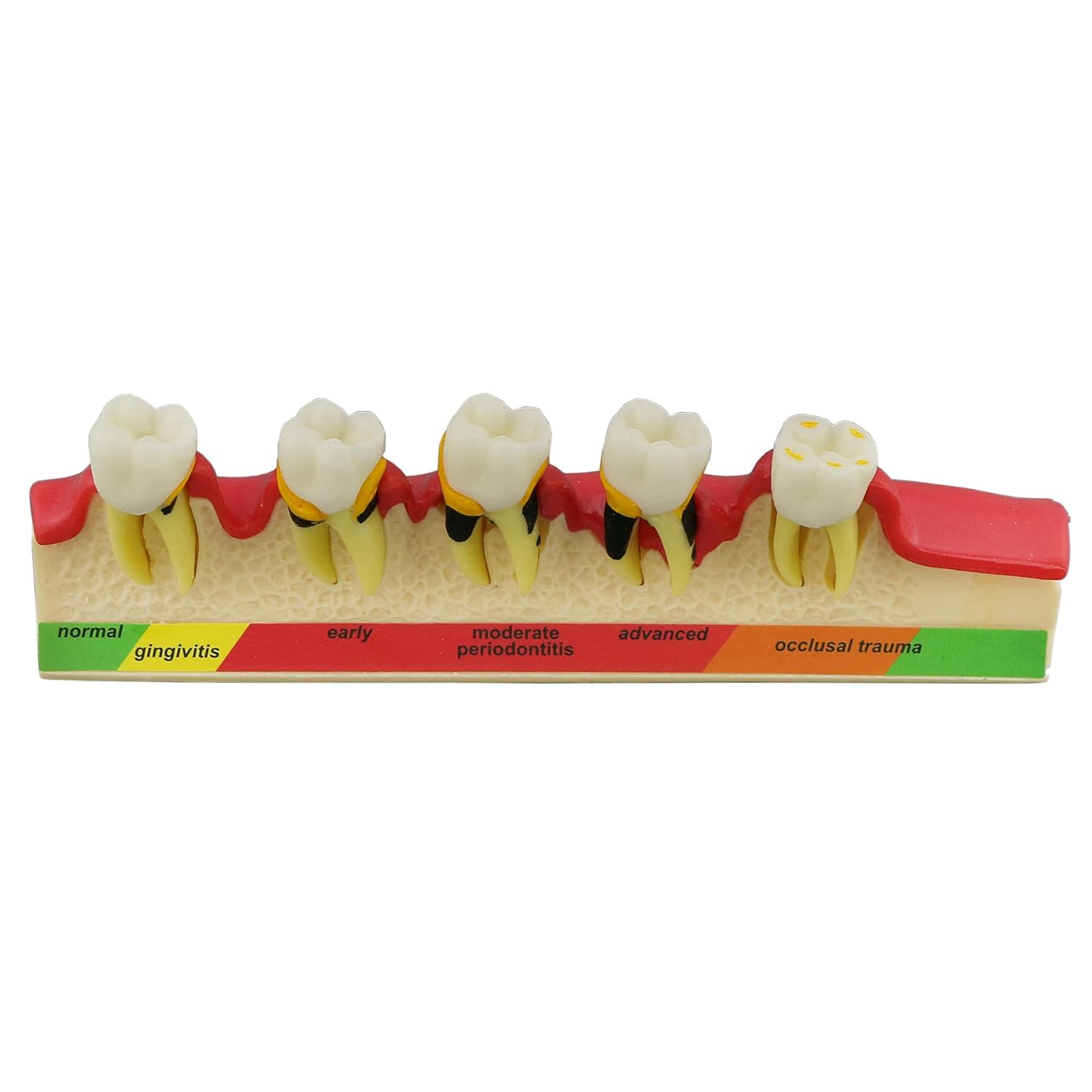 Teeth Periodontal Disease Model Dental Caries Nepal | Ubuy