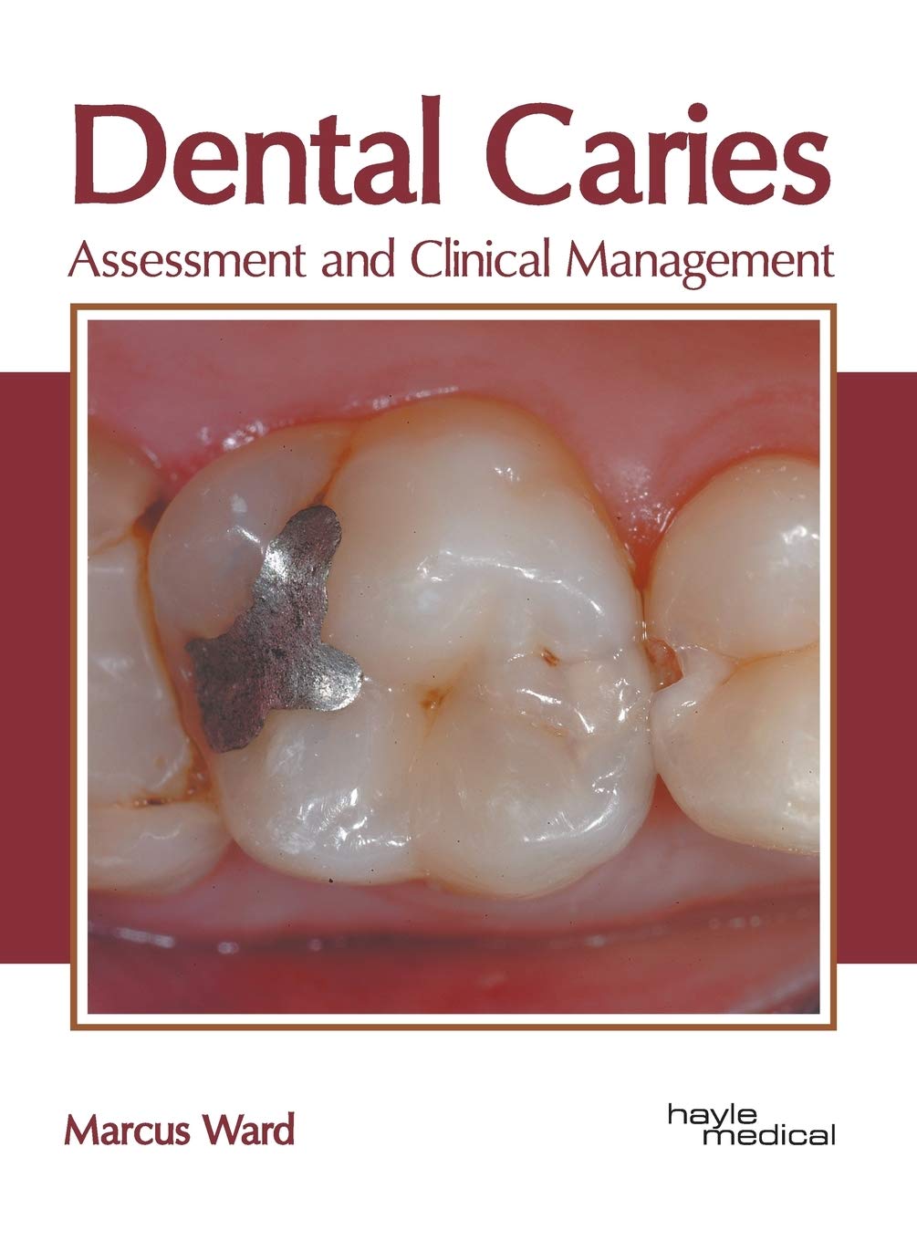 Dental Caries: Assessment and Clinical Management: 9781632415660 ...