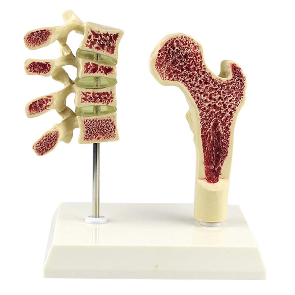 Buy Study Model Life Size Human Lumbar Vertebra Thigh Osteoporosis ...