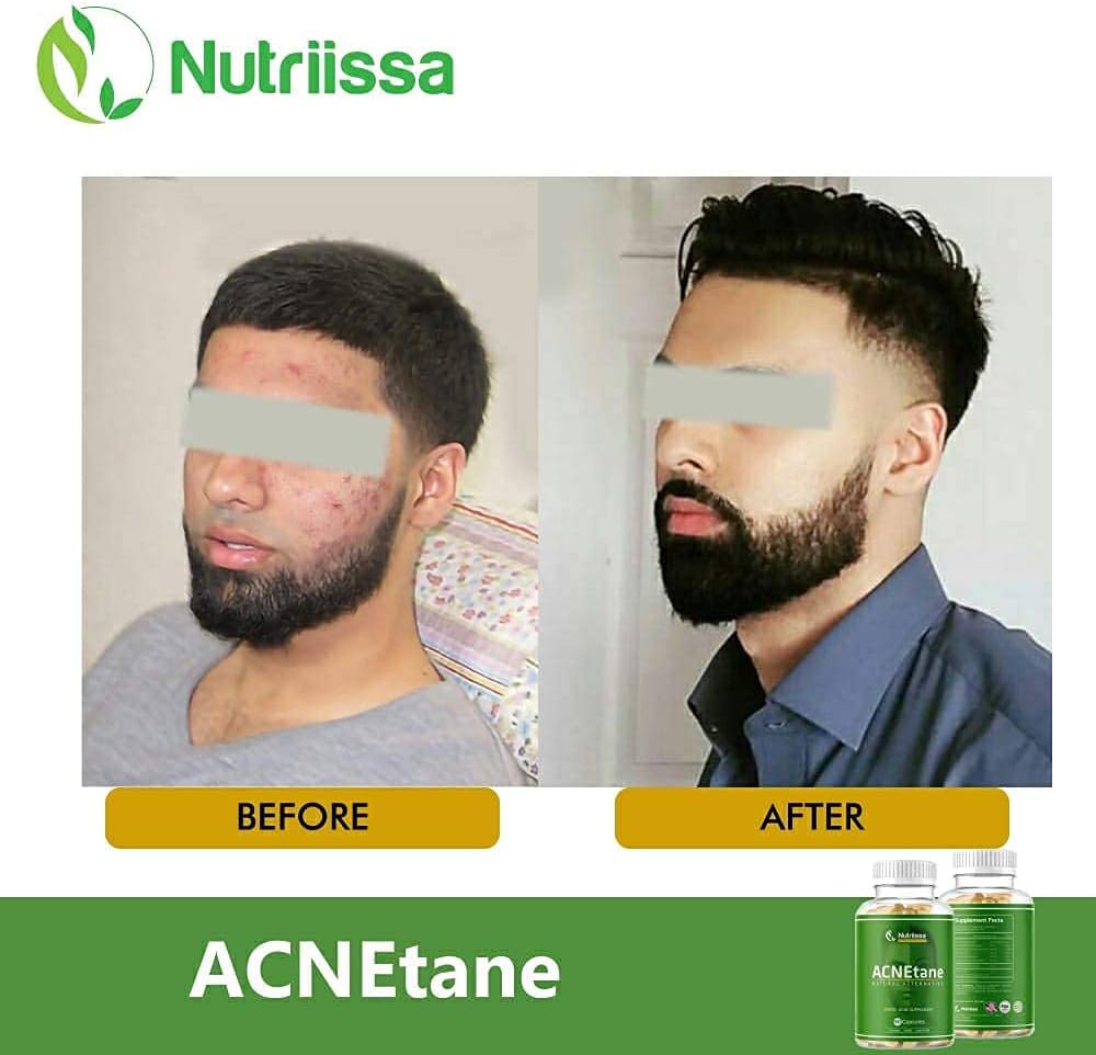 Buy ACNEtane - All Natural Vitamin Supplement for Treating Acne, 90 ...