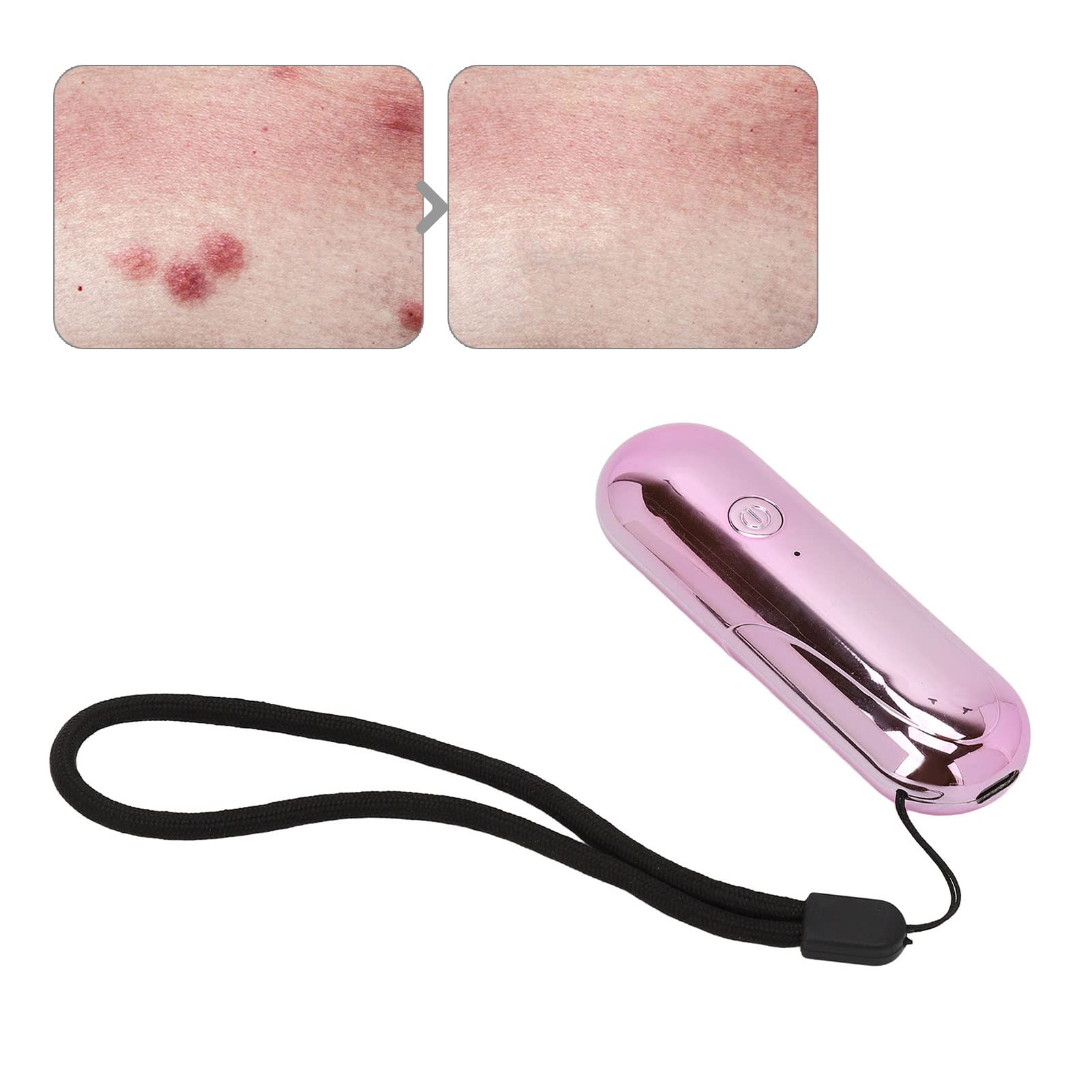 Tmishion Insect Bite Relief And Healer Bite Helper Electronic Mosquito ...