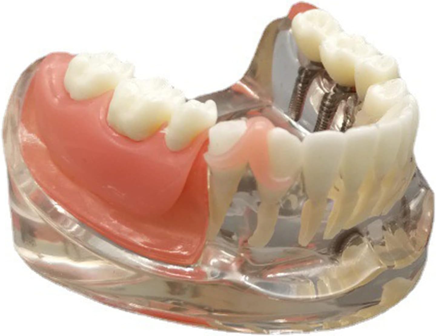 Dental Restoration Model Teeth Model Demo Dental Implants Bridge ...