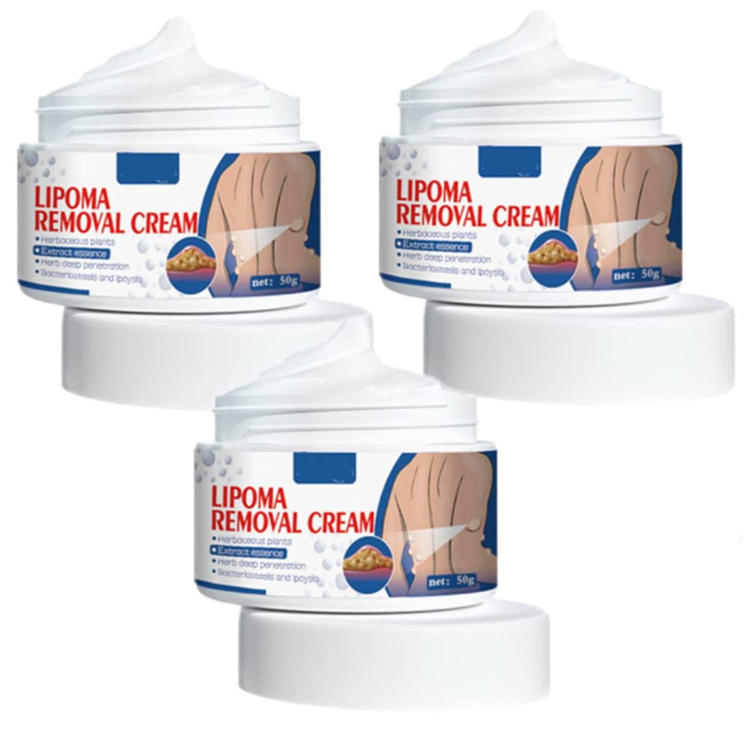 Lumpfree Lipoma Removal Cream Instant Lipoma Removal Cream Herbal ...