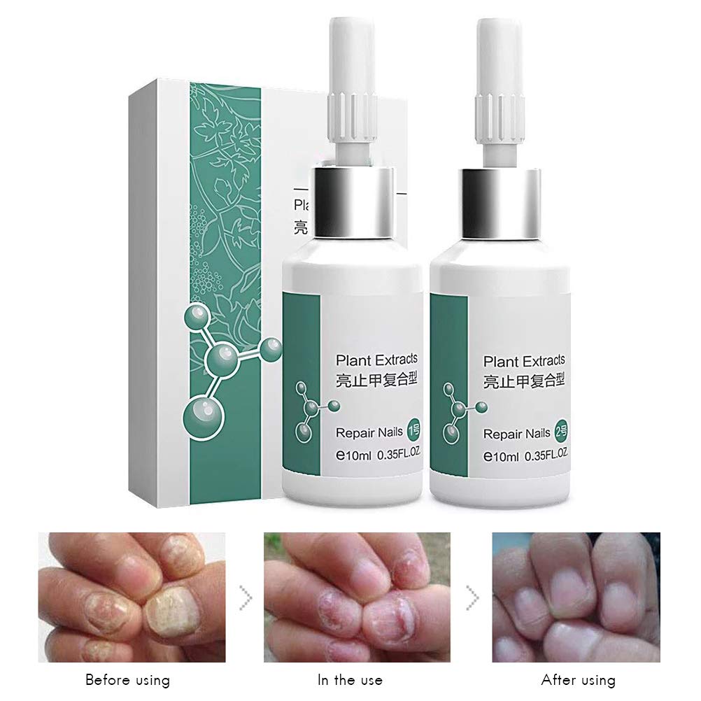 Buy Nail Fungus , Fungus Stop, Maximum Strength Anti-Fungal Nail ...