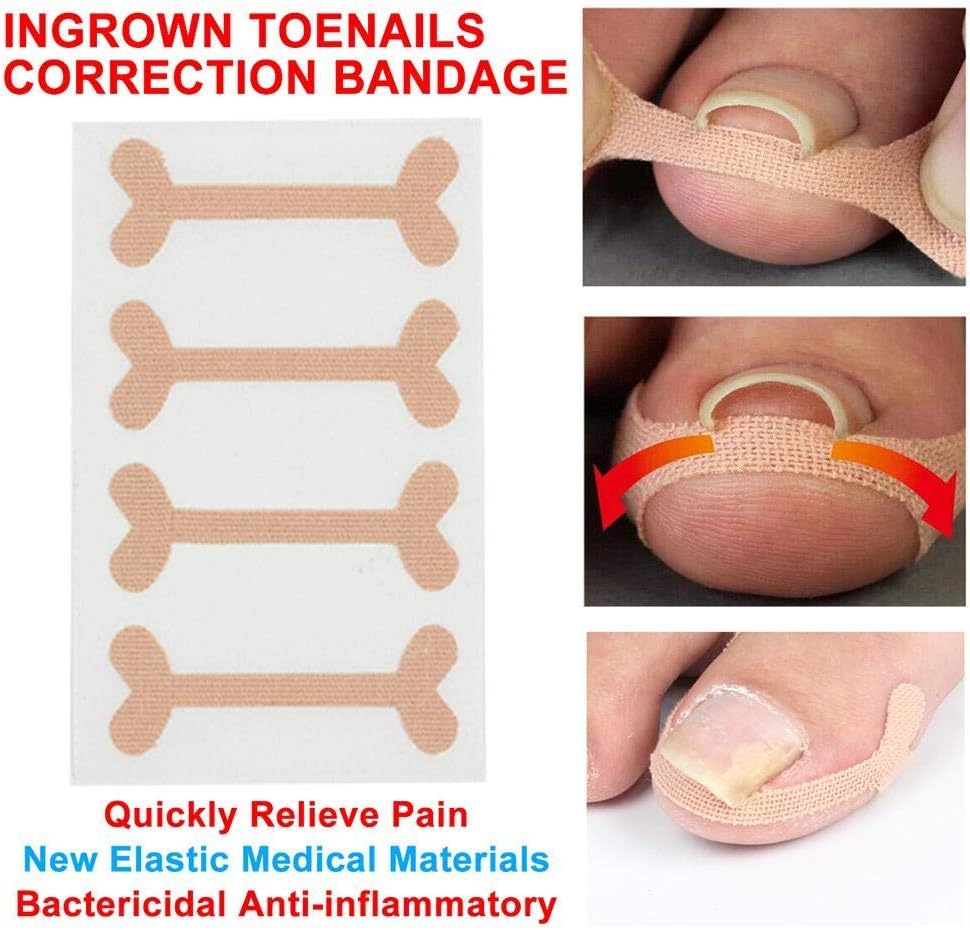 32 pcs Ingrown Toenail Correction Patch, Breathable Elastic Cotton Glue ...