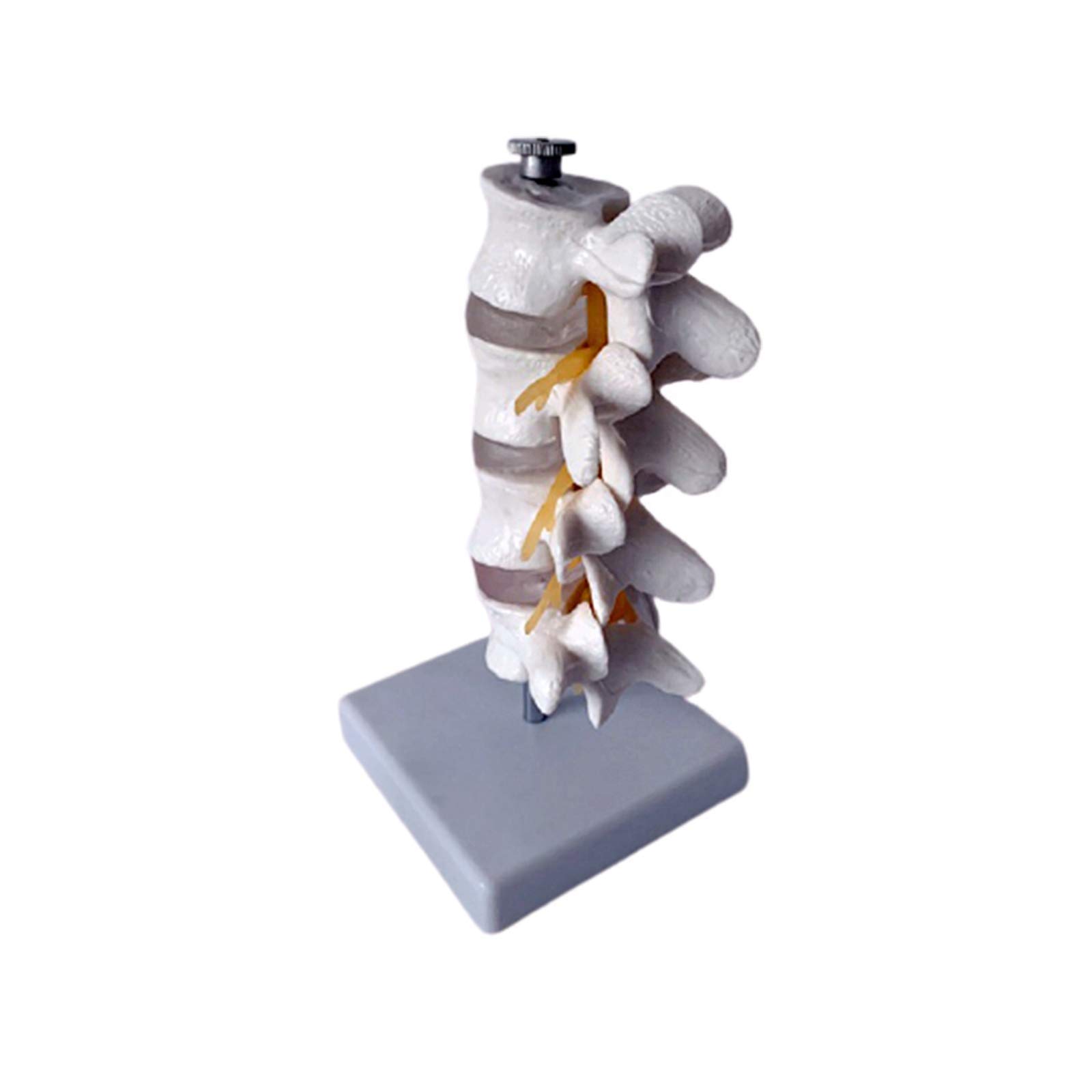 XIEZI Anatomical Model Lumbar Disc Herniation Demonstration Model ...