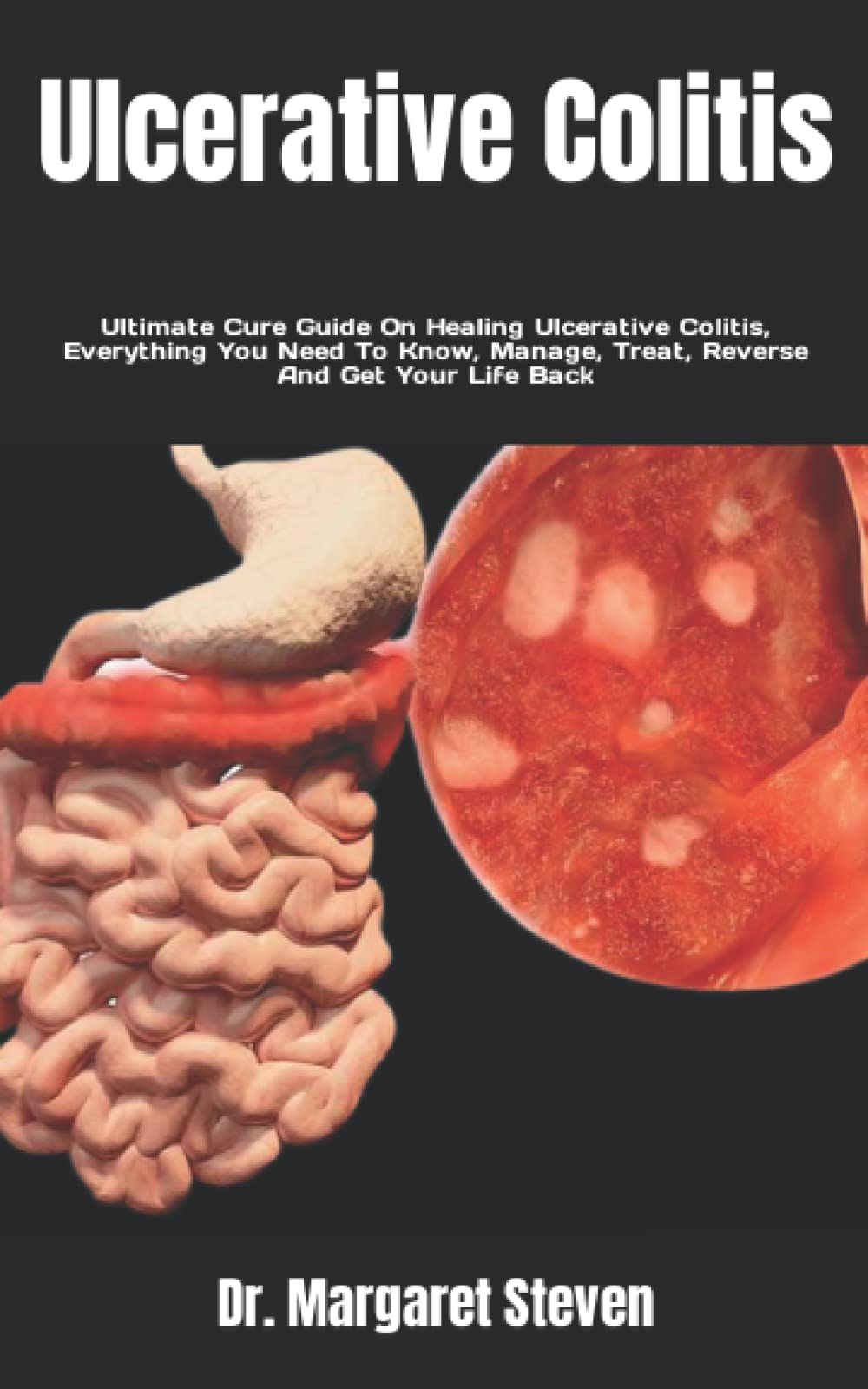 Buy Ulcerative Colitis: Ultimate Cure Guide On Healing Ulcerative ...