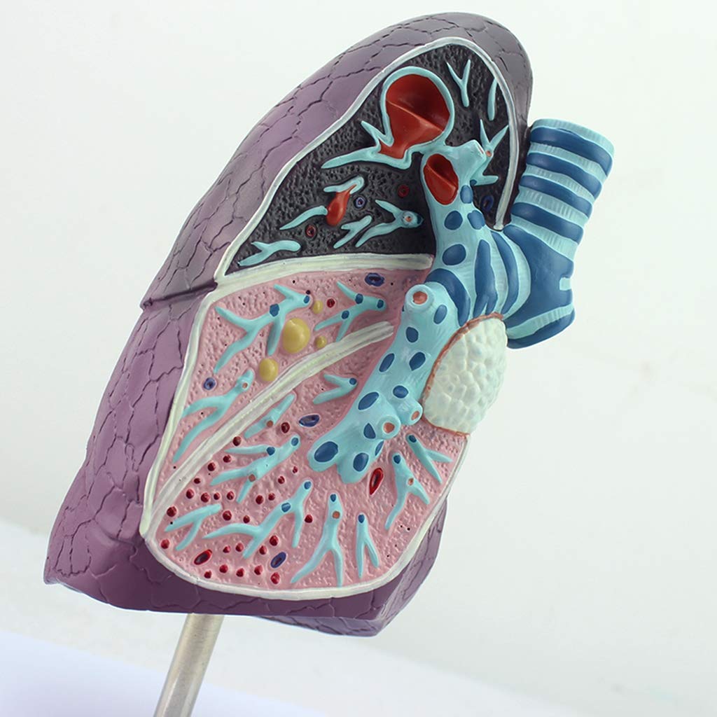 Buy Anatomical Lung Model - Smoker's Pathological Tuberculosis ...