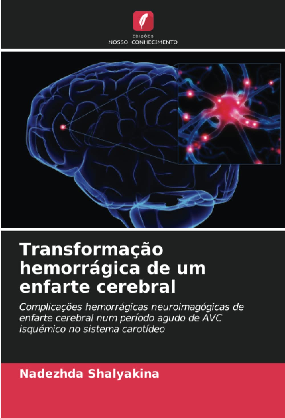 Buy Transformação hemorrágica de um enfarte cerebral: Complicações ...