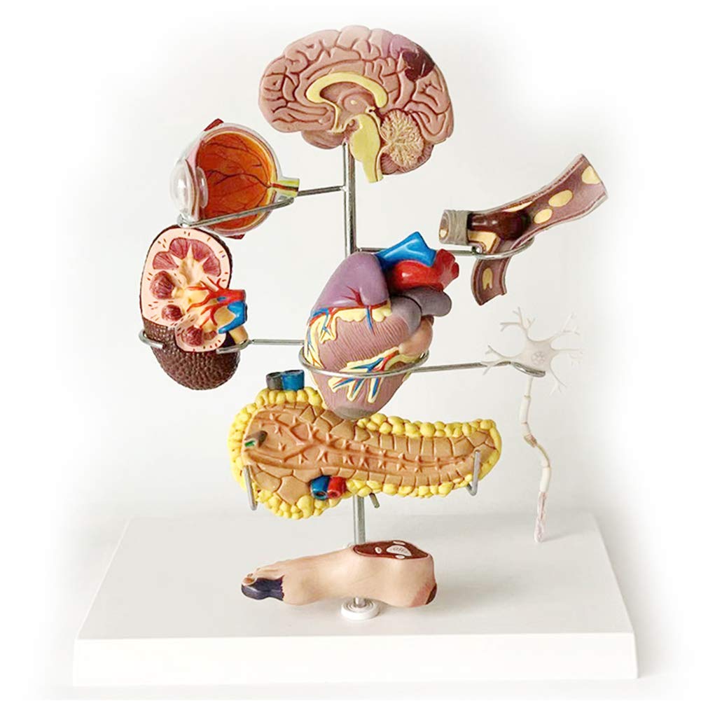 Anatomy Diabetic Model Human Pathologicy Brain Eye Heart Kidney Blood ...