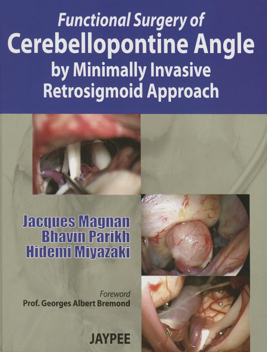 Buy Functional Surgery of Cerebellopntine Angle by Minimally Invasive ...