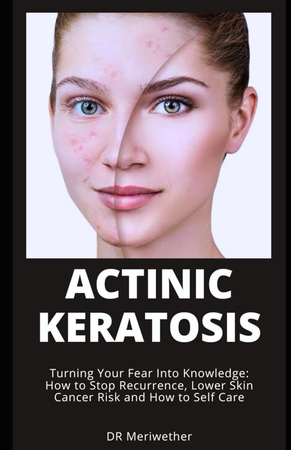 ACTINIC KERATOSIS: Turning Your Fear Into Knowledge: How to Stop ...