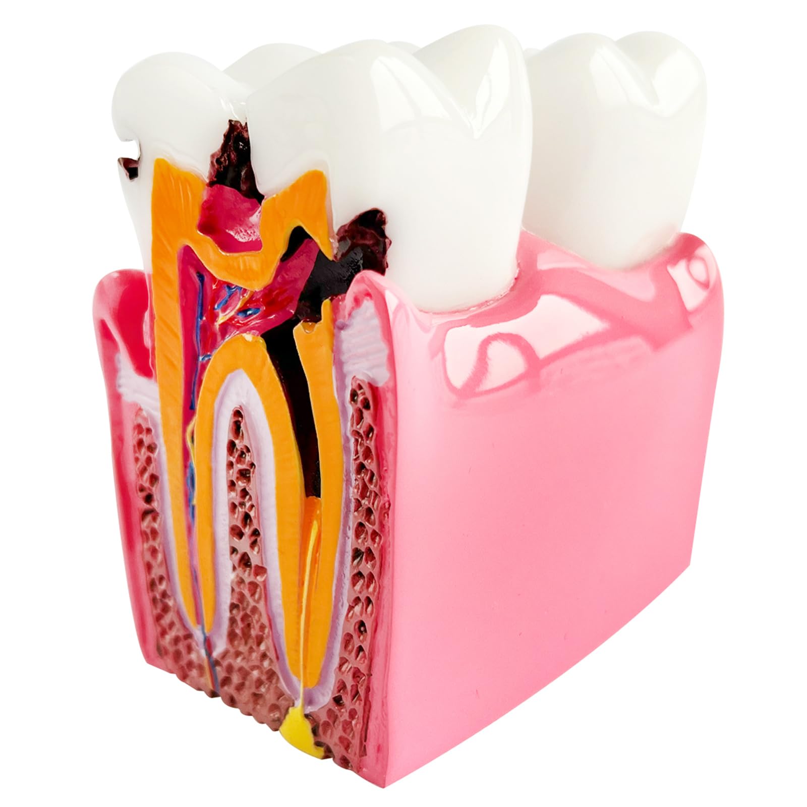 Amazon.com: Dental Caries Teeth Model, 3.4 x 3 x 2 Inches - 6 Times ...