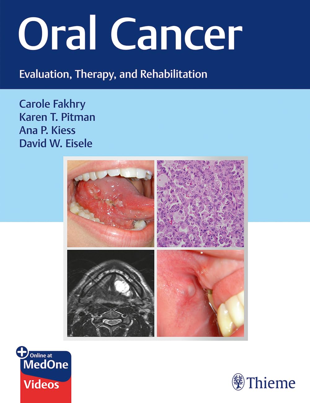 Oral Cancer: Evaluation, Therapy, and Rehabilitation: 9781626239685 ...