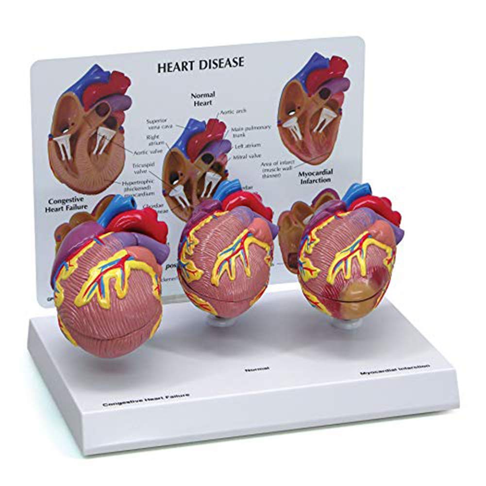 Buy DBSCD Human Organ Model, Heart Pathology Model, Reduced Version of ...