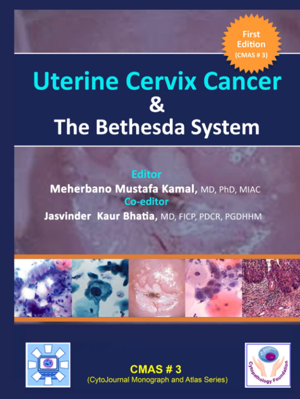 Uterine Cervix Cancer The Bethesda System: CMAS # 3 (CMAS (CytoJournal ...